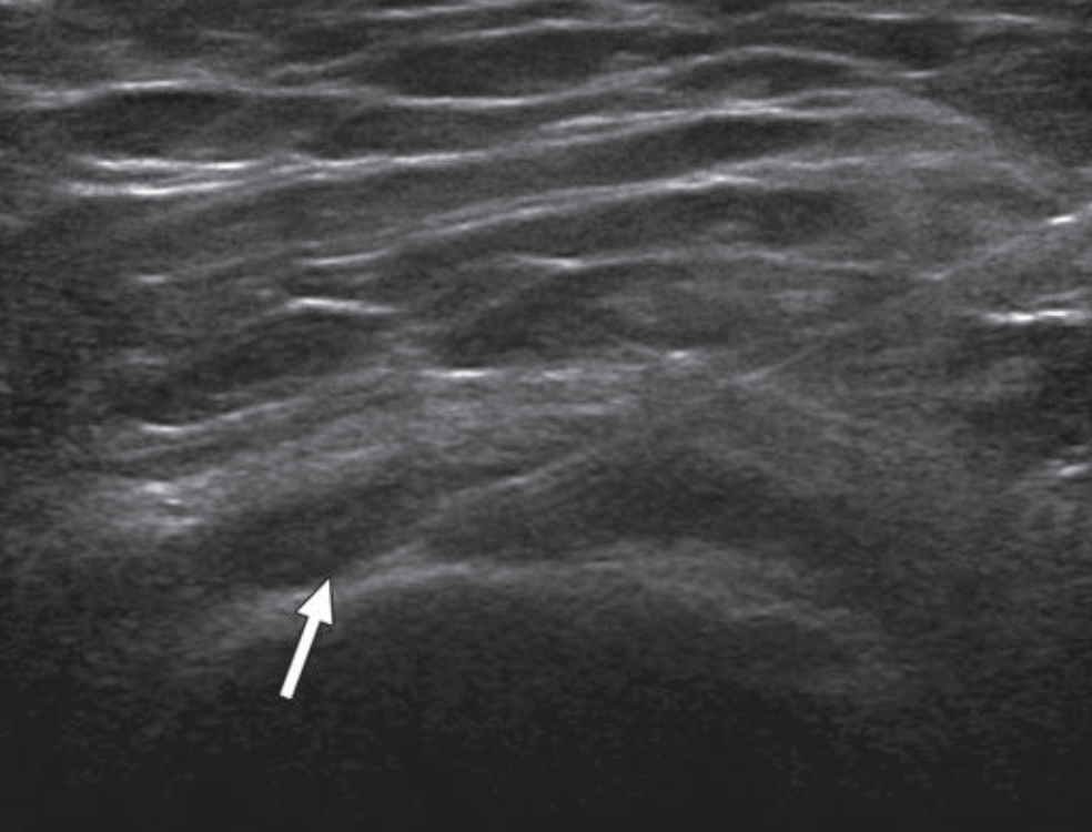 Ultrasound guided injections of the trochanteric bursa
