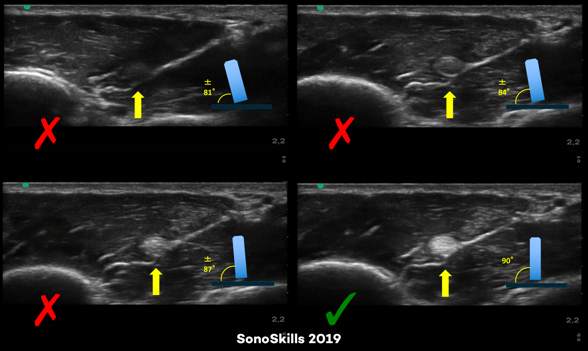 Anisotropy as most important pitfall in ultrasound imaging