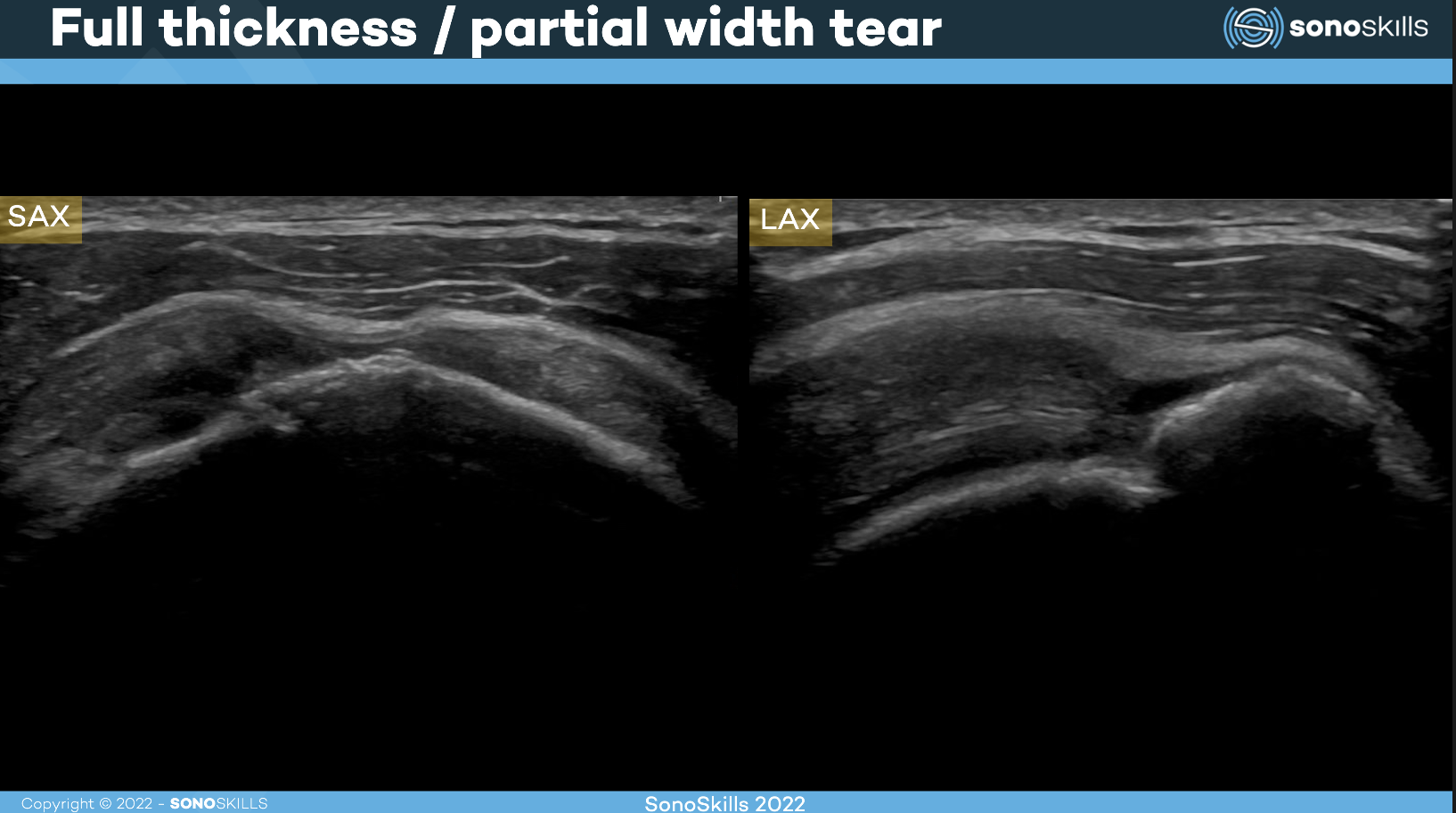 Knowledge on Rotator Cuff Tears You Should Know Before Starting a ...